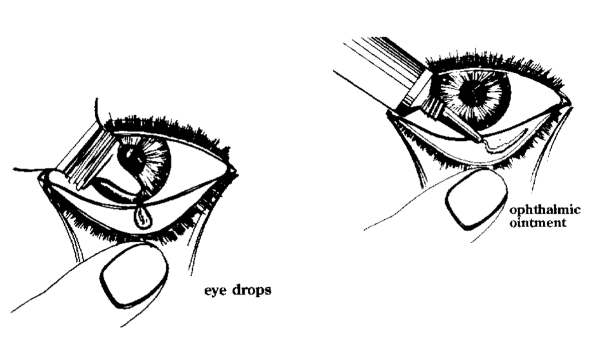Eye Drop Application North Texas Eye Center